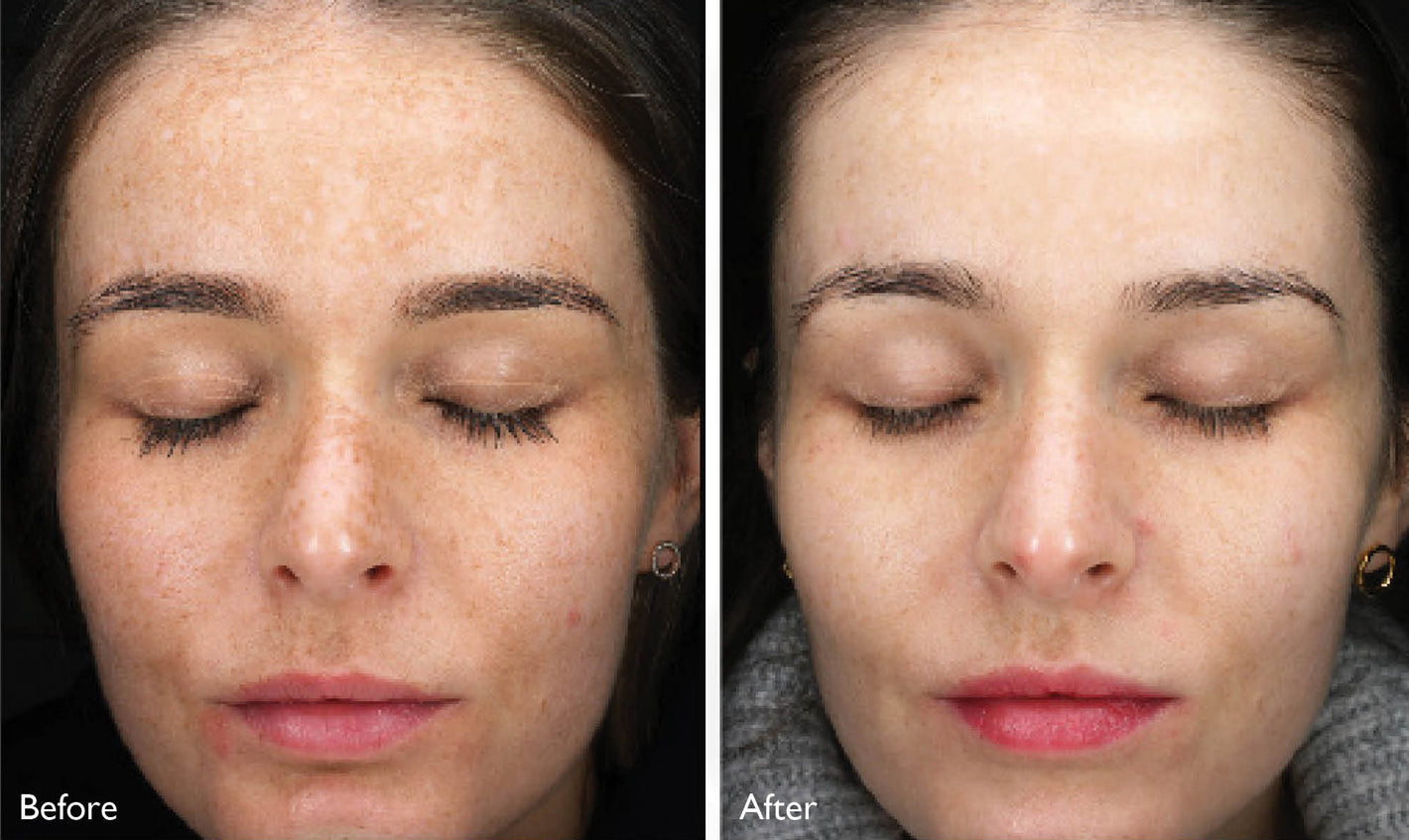 DermaFrac (microneedling) – CosMedic Clinic