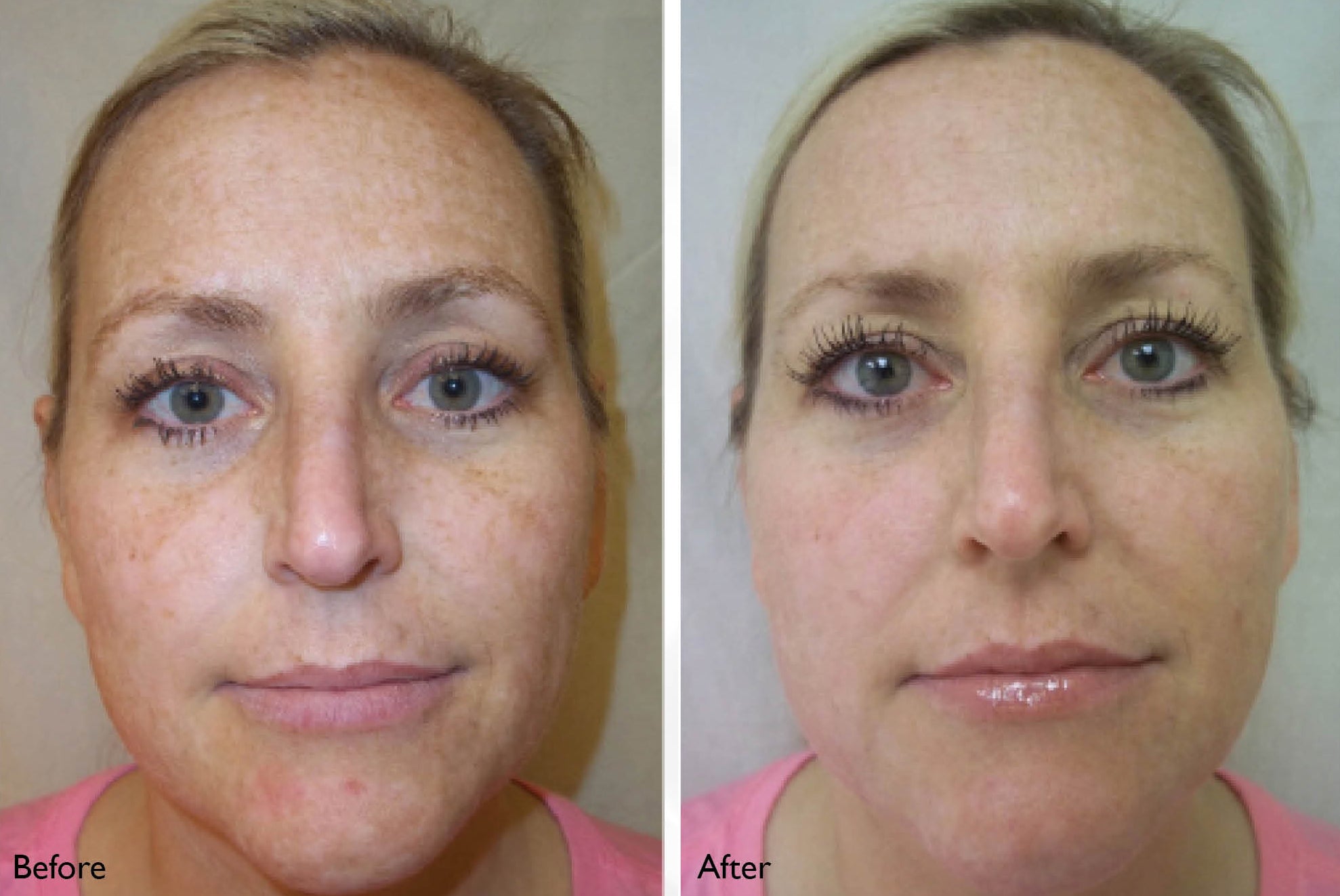 DermaFrac (microneedling) – CosMedic Clinic