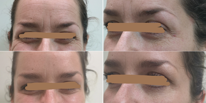 Botox / Xeomin – CosMedic Clinic