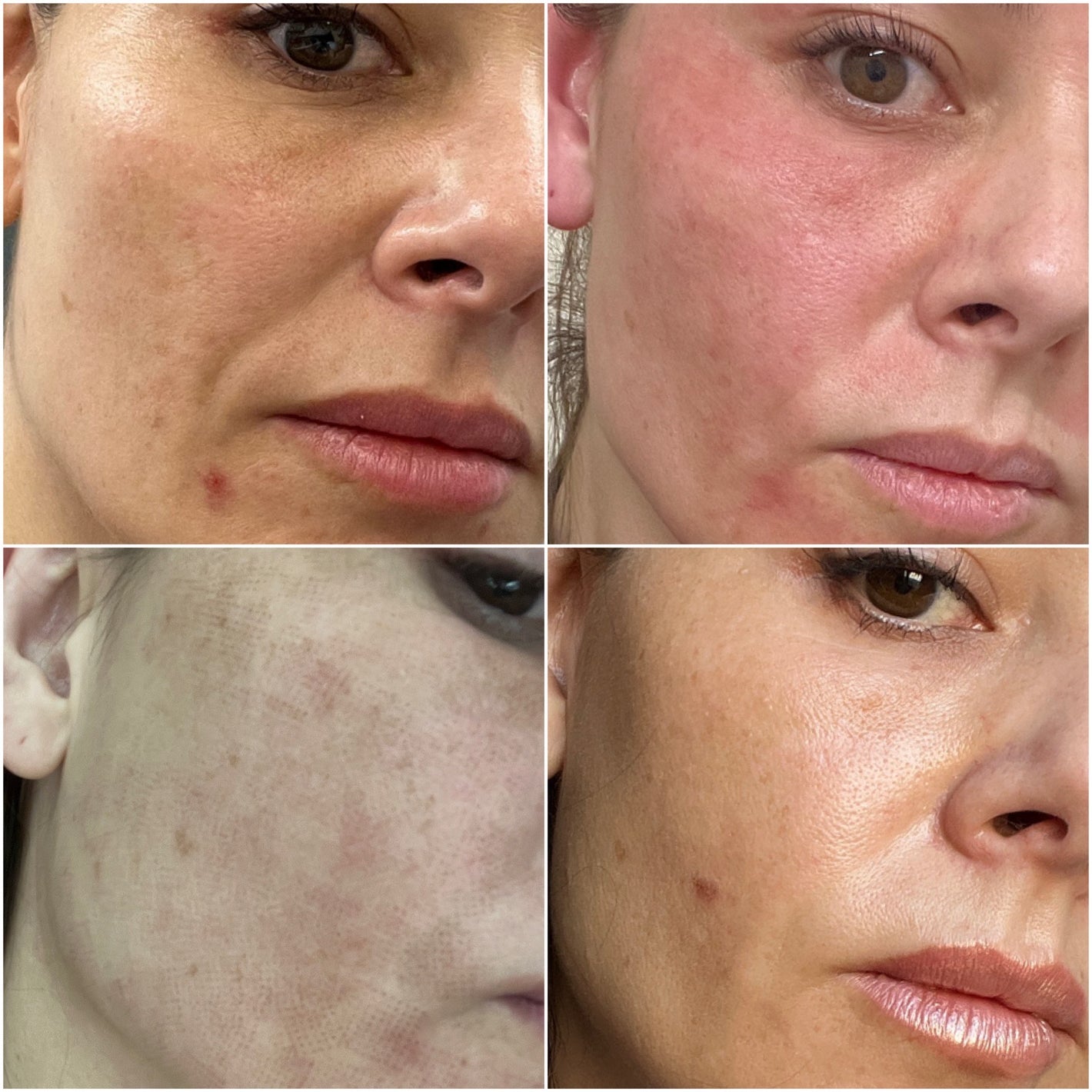 Tixel – CosMedic Clinic